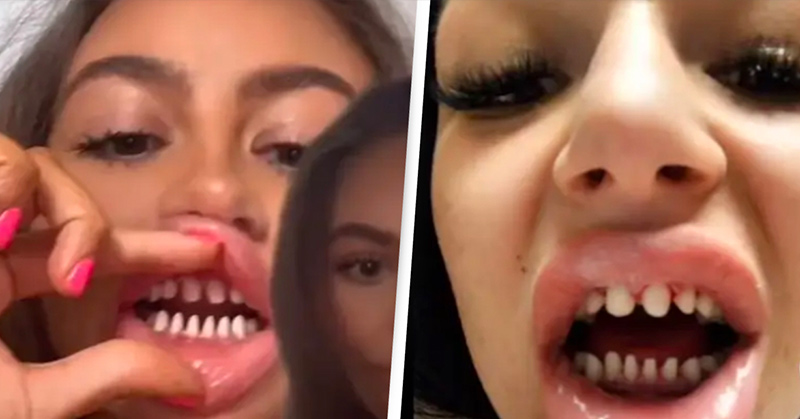 Teeth-Shaving TikTokers Will Need Dentures By Their 40s, Dentists Say