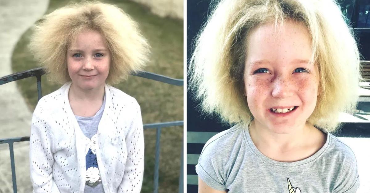 Little Girl With 'Uncombable Hair Syndrome' Rocks Her Unique Style ...