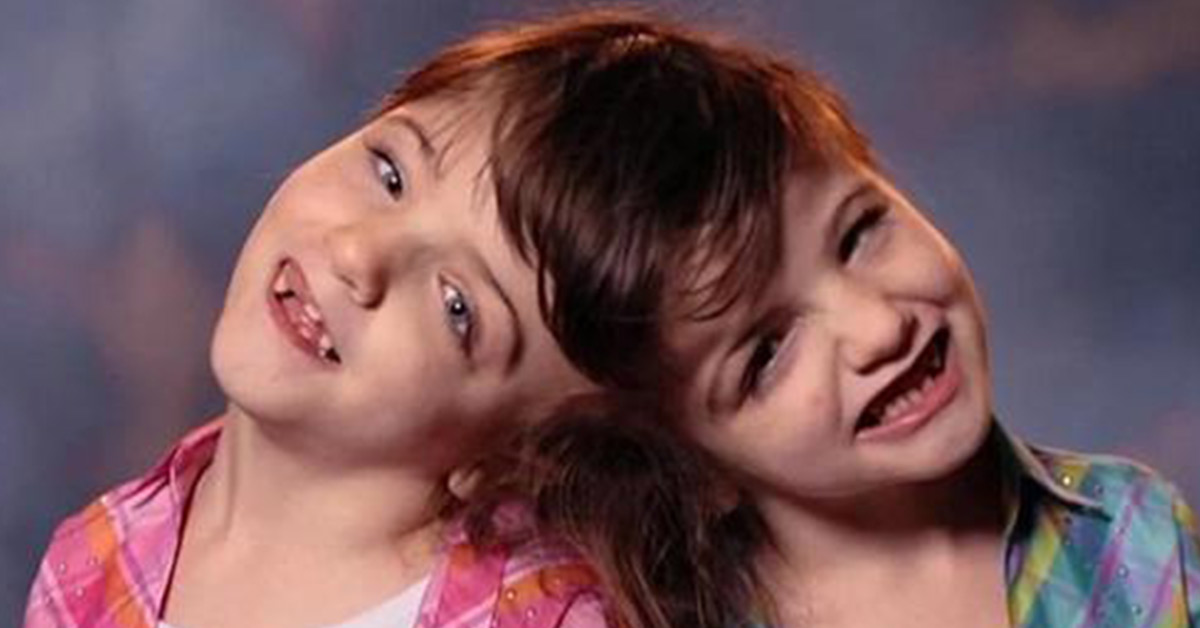 The Incredible Twins Who Share A Brain And Can See Through Each Other's ...